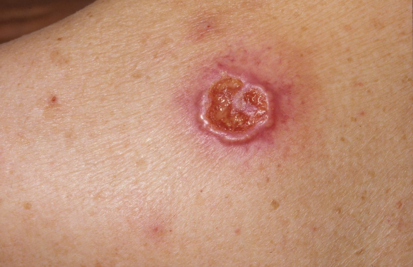 Jetzt Basalzellkarzinom behandeln mit derma2go